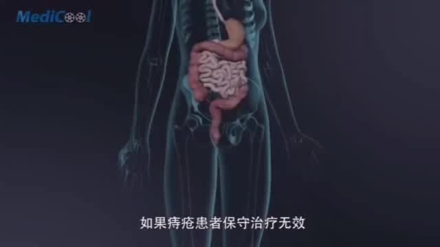 3D演示痔疮切除手术的全过程,原来也没那么可怕