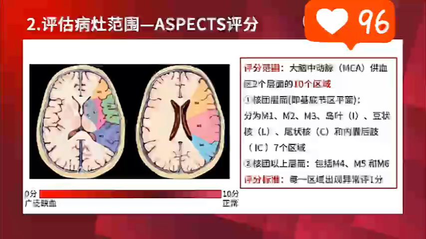 急诊影像学高级培训班:第一章:急性缺血性脑卒中及影像学评估
