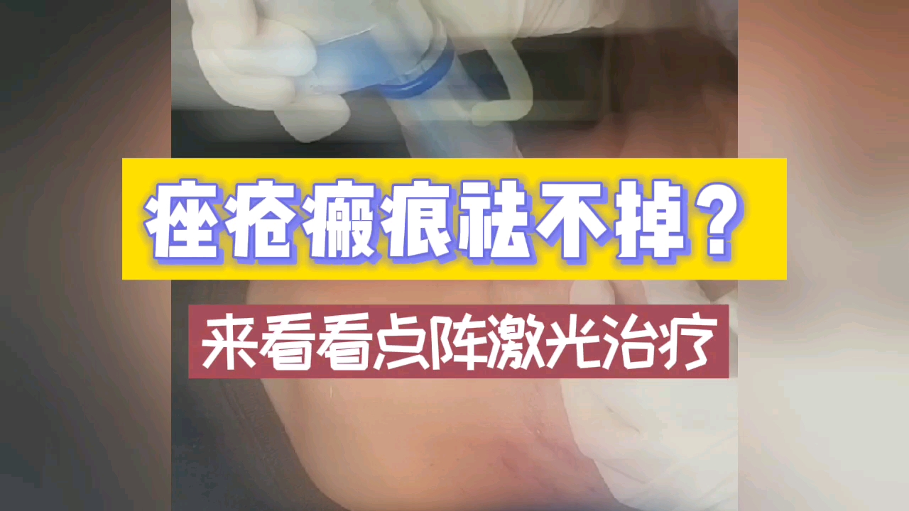 痤疮瘢痕祛不掉?来看看点阵激光治疗!【中山肤斗士】