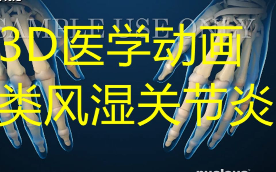 类风湿关节炎-3D医学动画