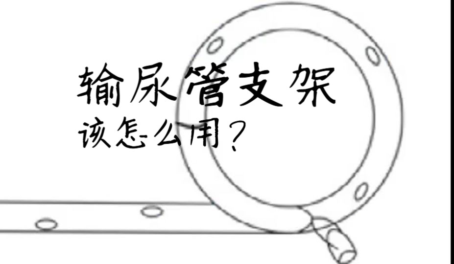 输尿管支架该怎么用?