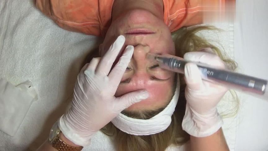 微针嫩肤系列三:微针除了紧致皮肤、去痘坑,还可以联合给药