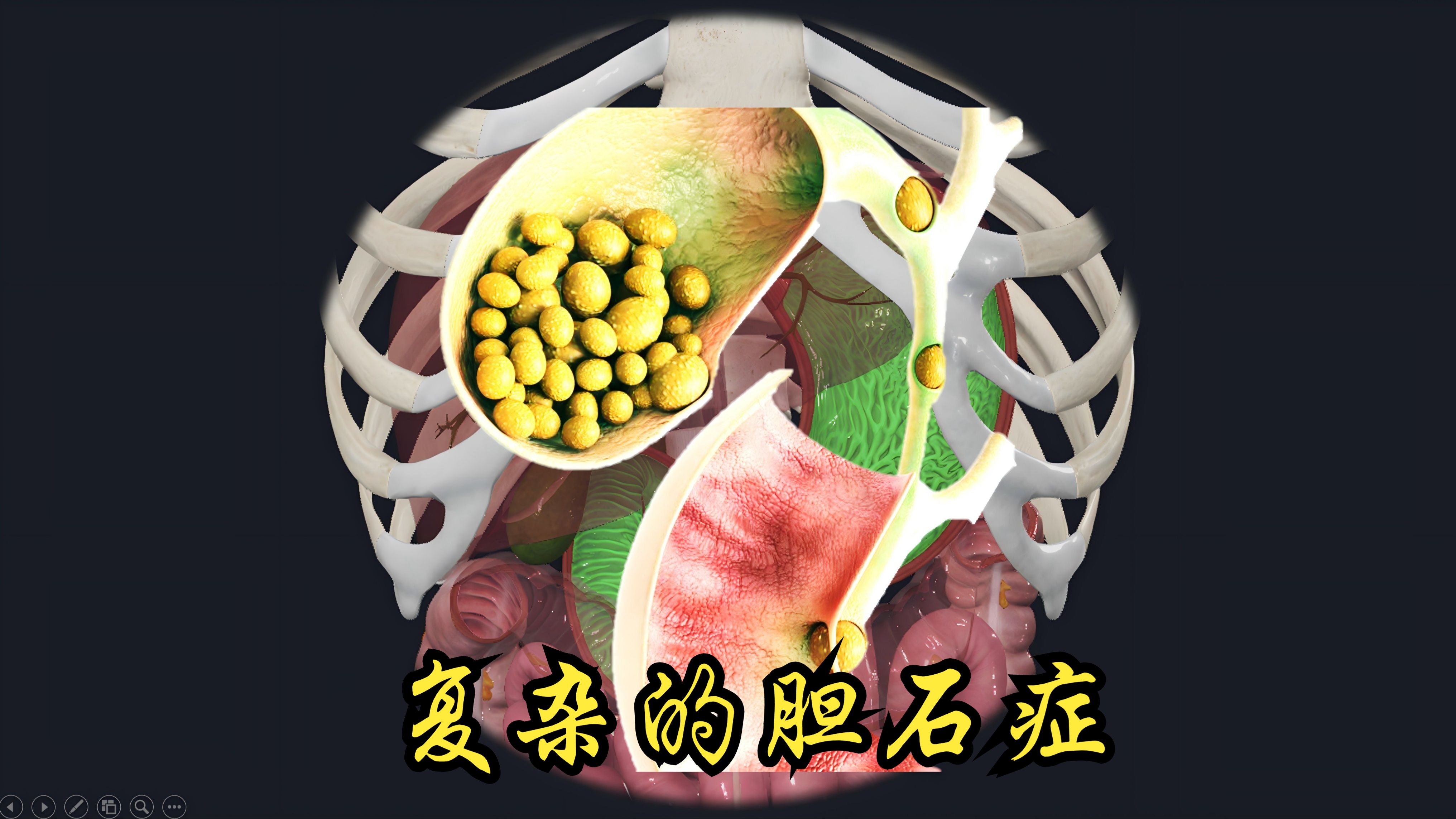 肝内、外胆管、胆囊、胆总管结石,原来胆石症这么复杂