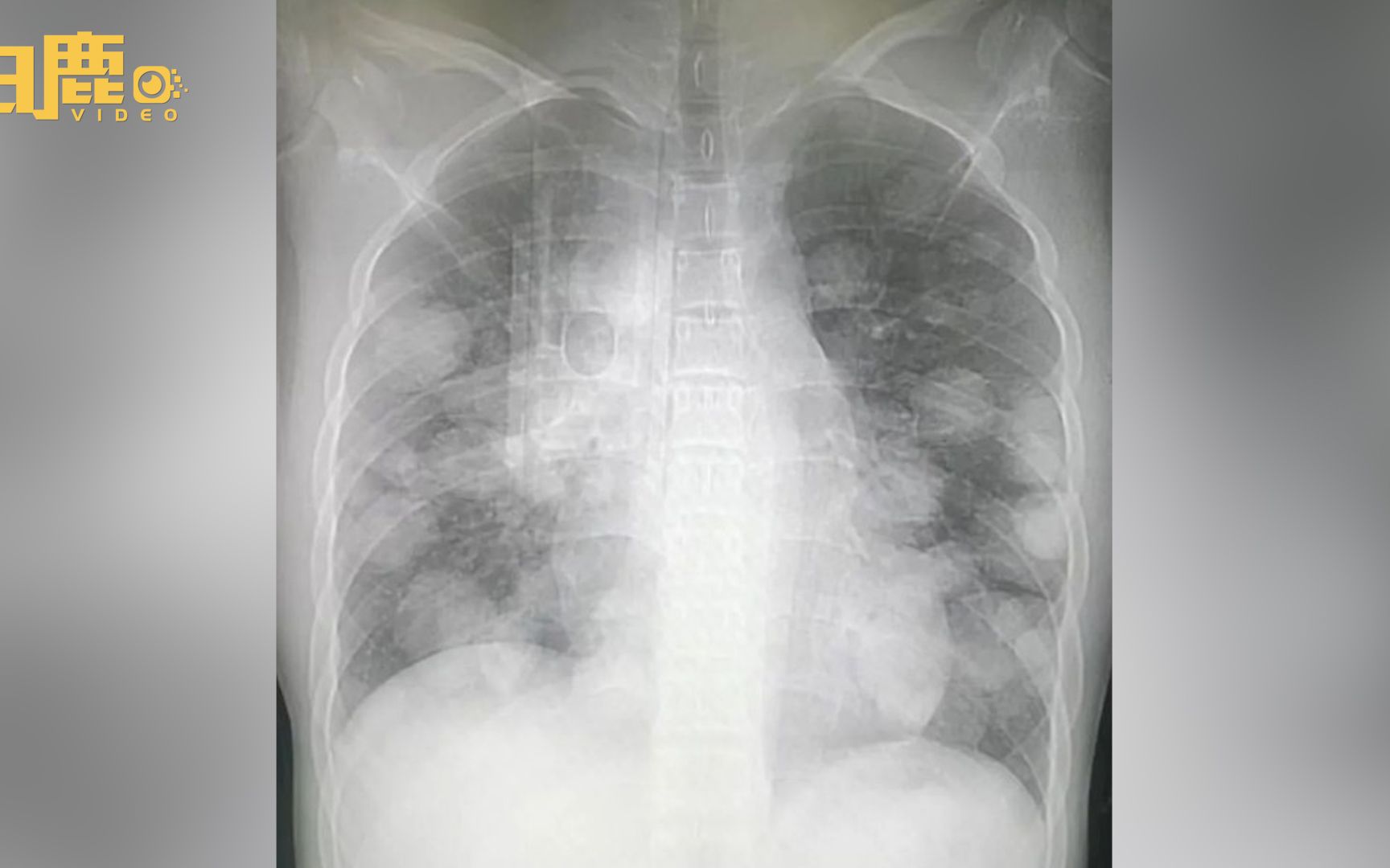 15岁男孩乳房发育似女孩查出胸腺长肿瘤,医生:有长期注射生长激素的...