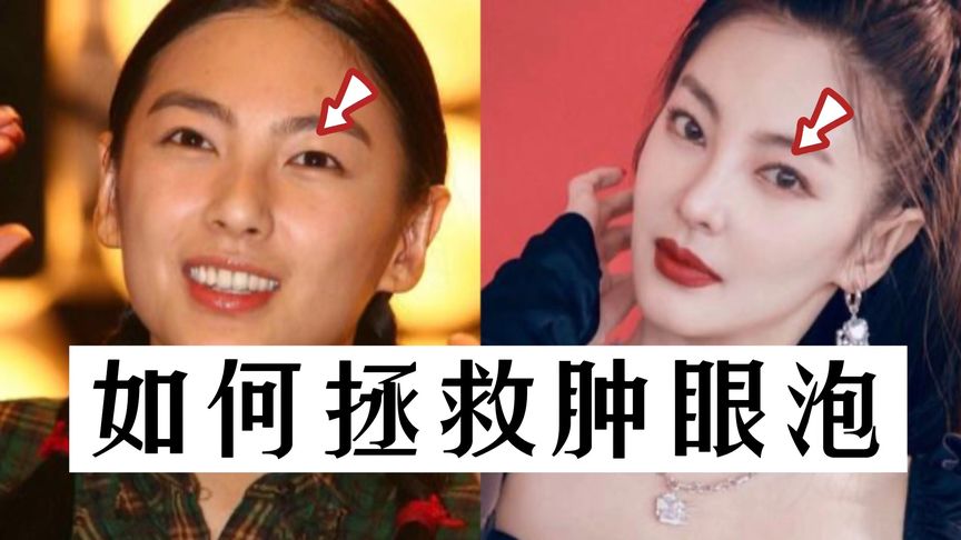 如何拯救肿眼泡?肿眼泡的都看过来