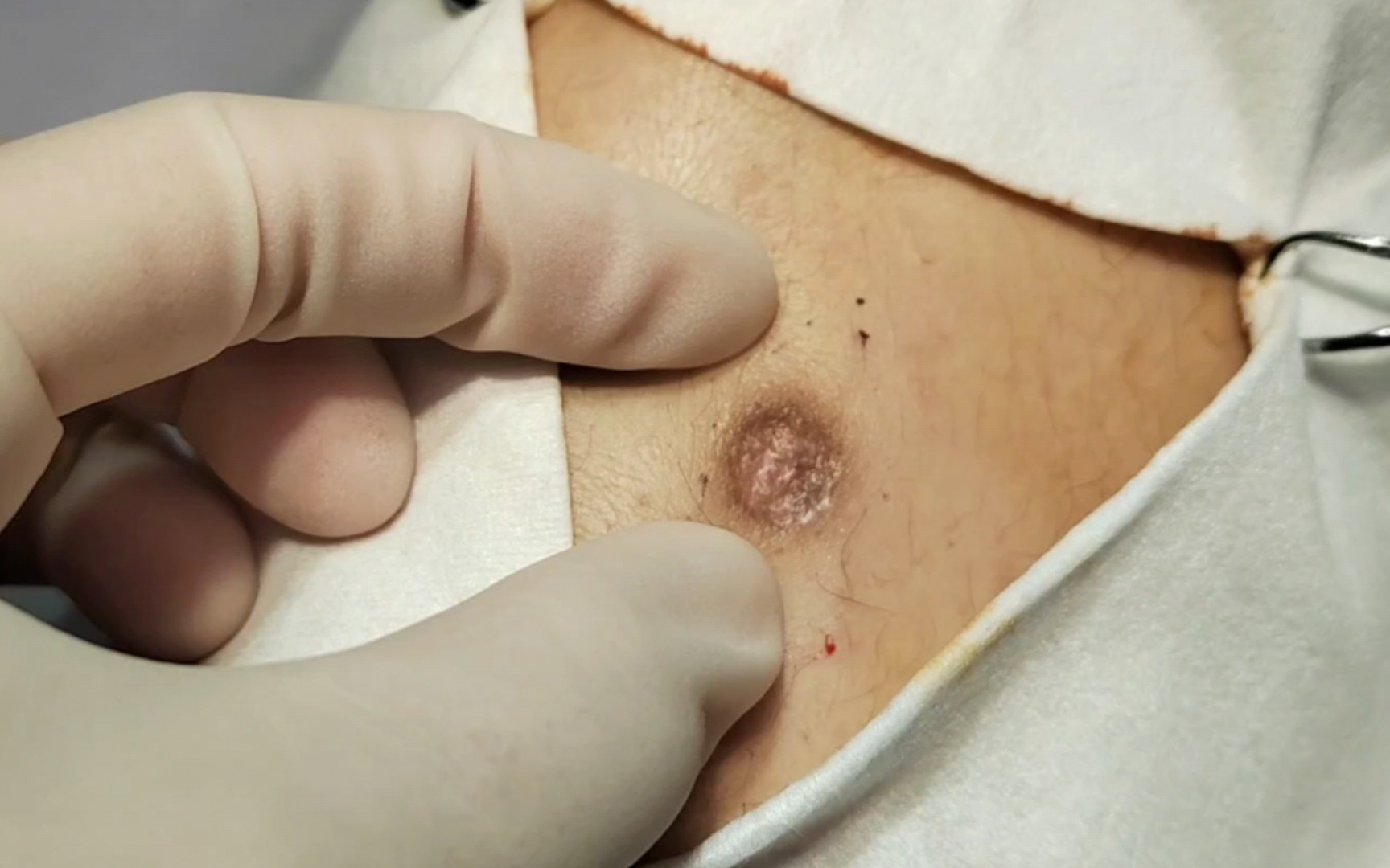 手术切除一例凹陷性瘢痕