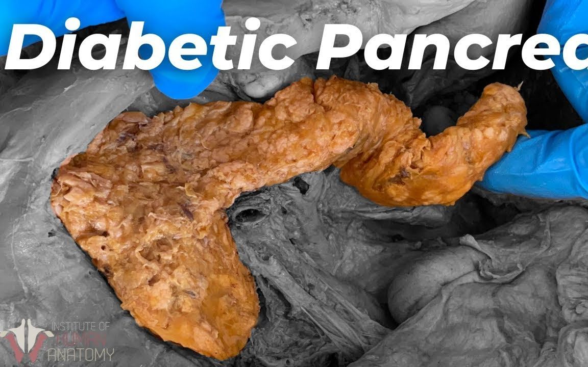 你得了糖尿病。以下是你身体的变化 | 大体老师来了