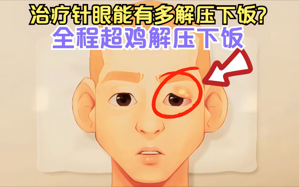 ...小哥突发眼睛肿的像鸡蛋,原因竟是长期熬夜得针眼!治疗过程超解压。