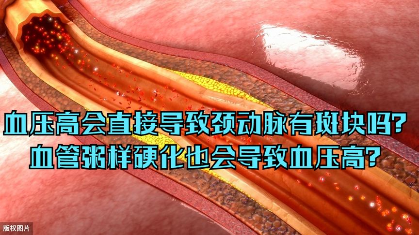 血压高会直接导致颈动脉有斑块吗?血管粥样硬化也会导致血压高?