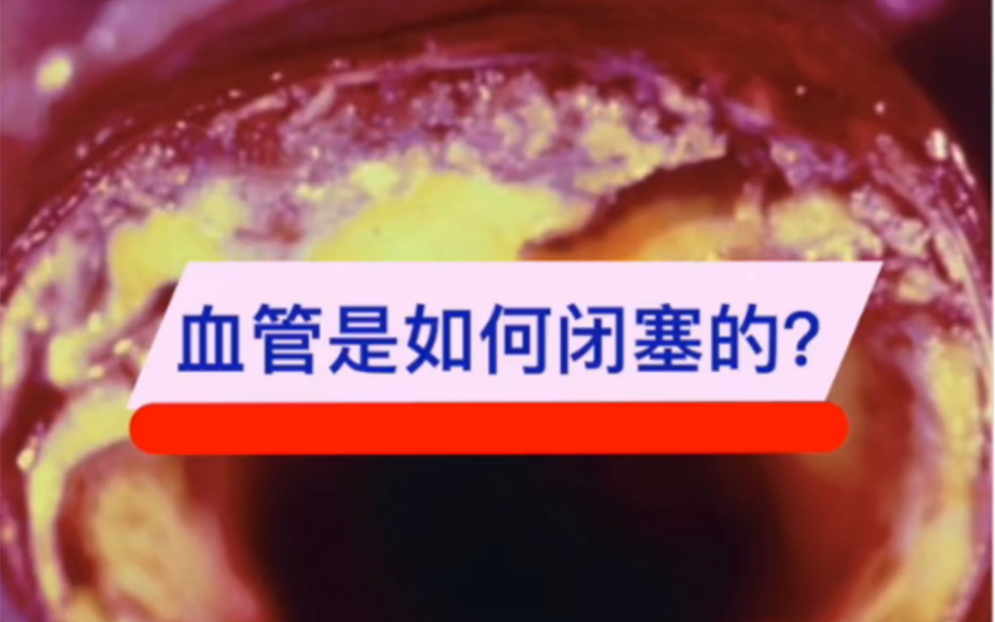 3D视频演示:脑梗心梗血管怎么闭塞的?看看这个动画和现场你就明白了...