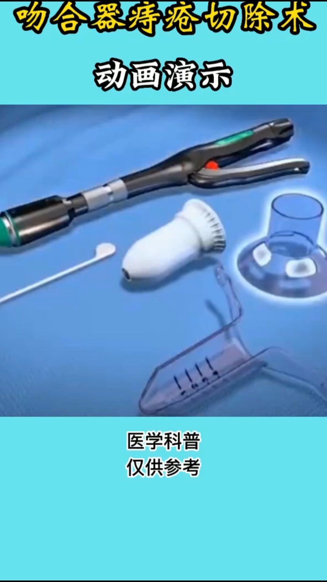 吻合器痔疮切除术