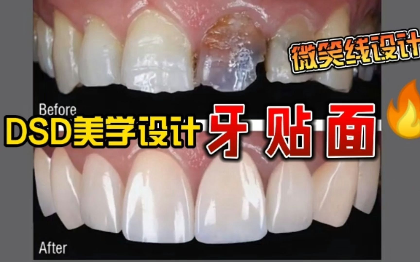 【牙科界的设计师】DSD美学设计微笑线!让牙贴面恢复完美笑容