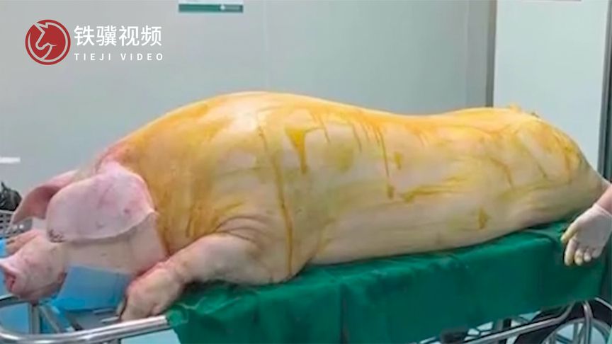 【#医院回应让烧伤病人移植猪皮#】