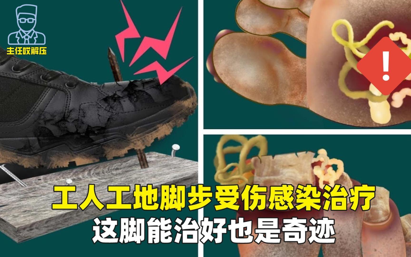解压动画,工人工地脚部受伤感染治疗,这脚能治好也是奇迹
