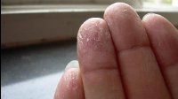 手掌、脚掌严重脱皮? 可能是患上了剥脱性角质松懈症剥脱性角质松懈症