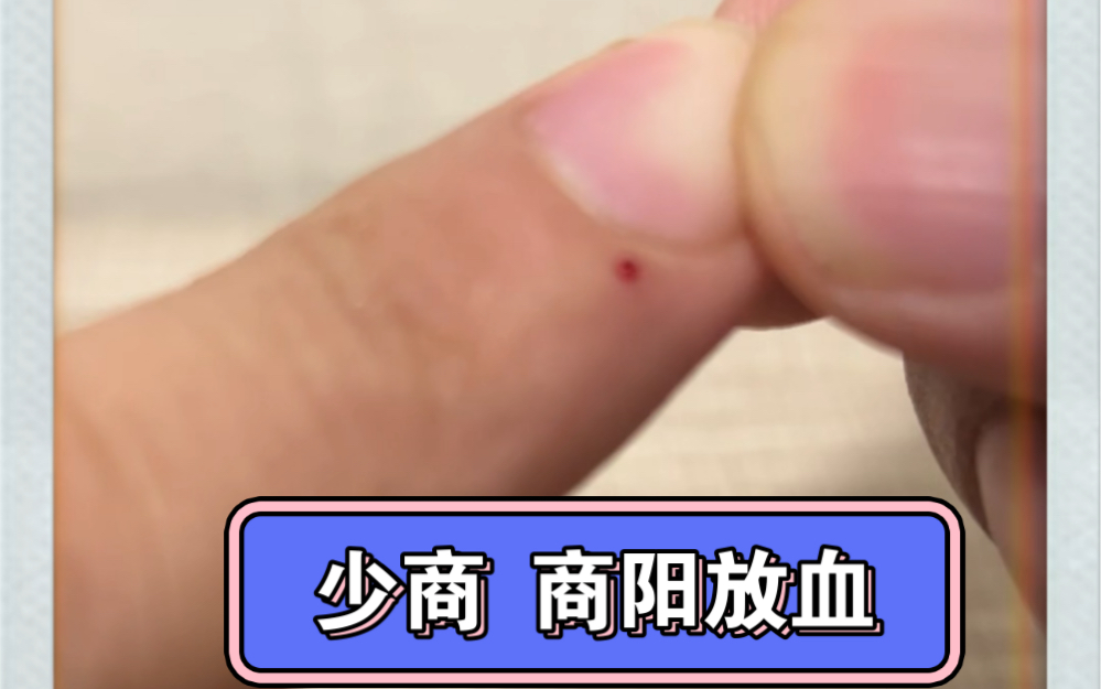 少商 商阳穴放血演示