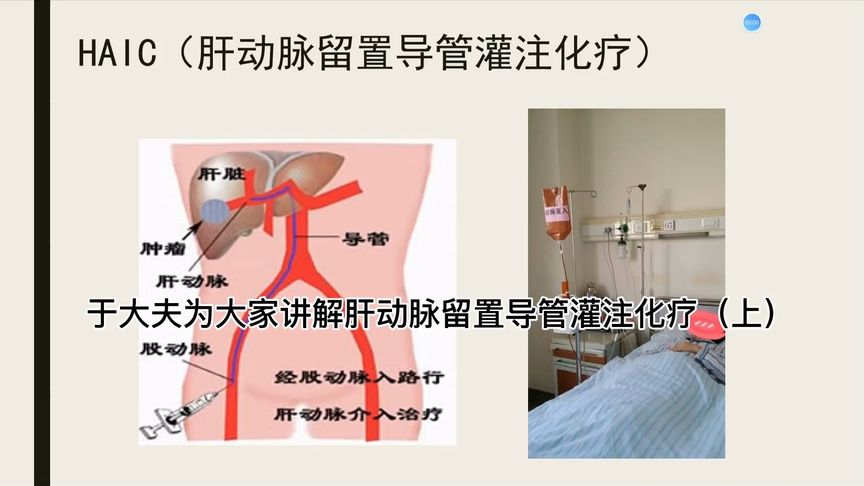 今天于大夫为大家讲解肝动脉留置导管灌注化疗