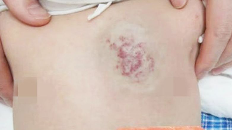 血管瘤可以自行消退,为什么还要进一步干预治疗呢?