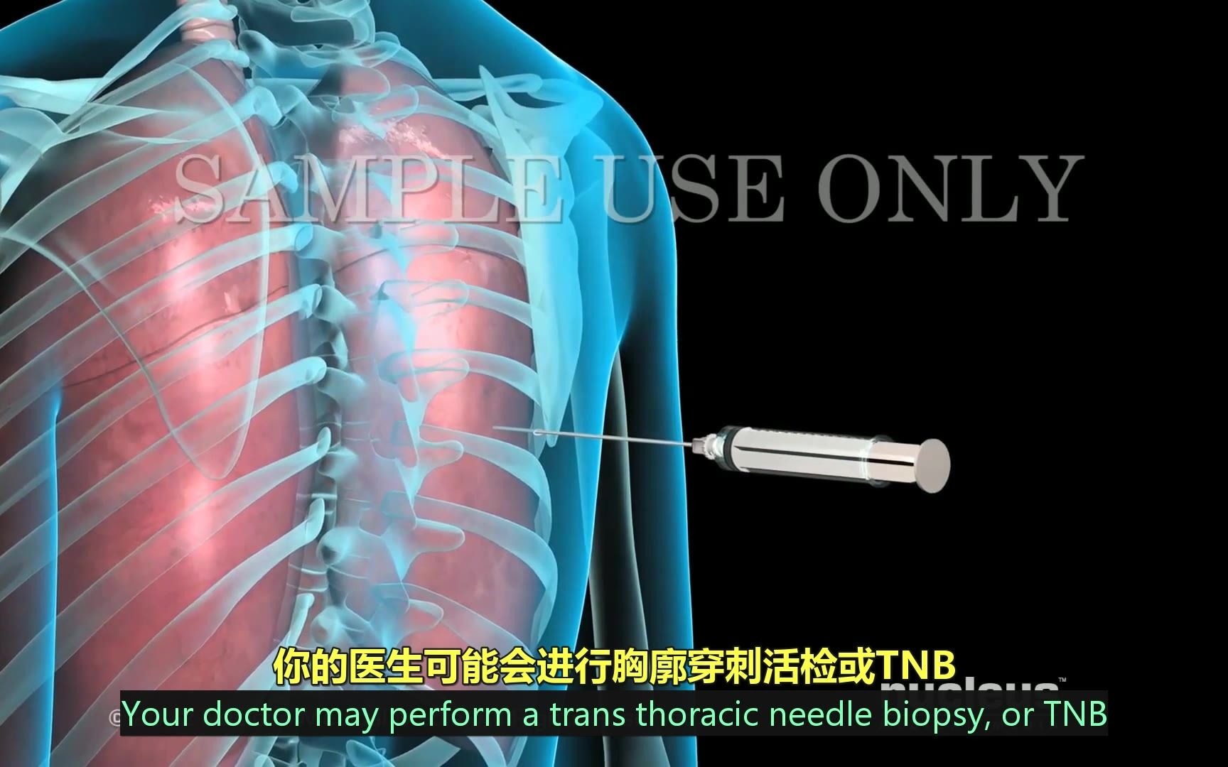 【3D医学动画】怕疼请勿代入!肺癌做穿刺活检(中英双字幕)