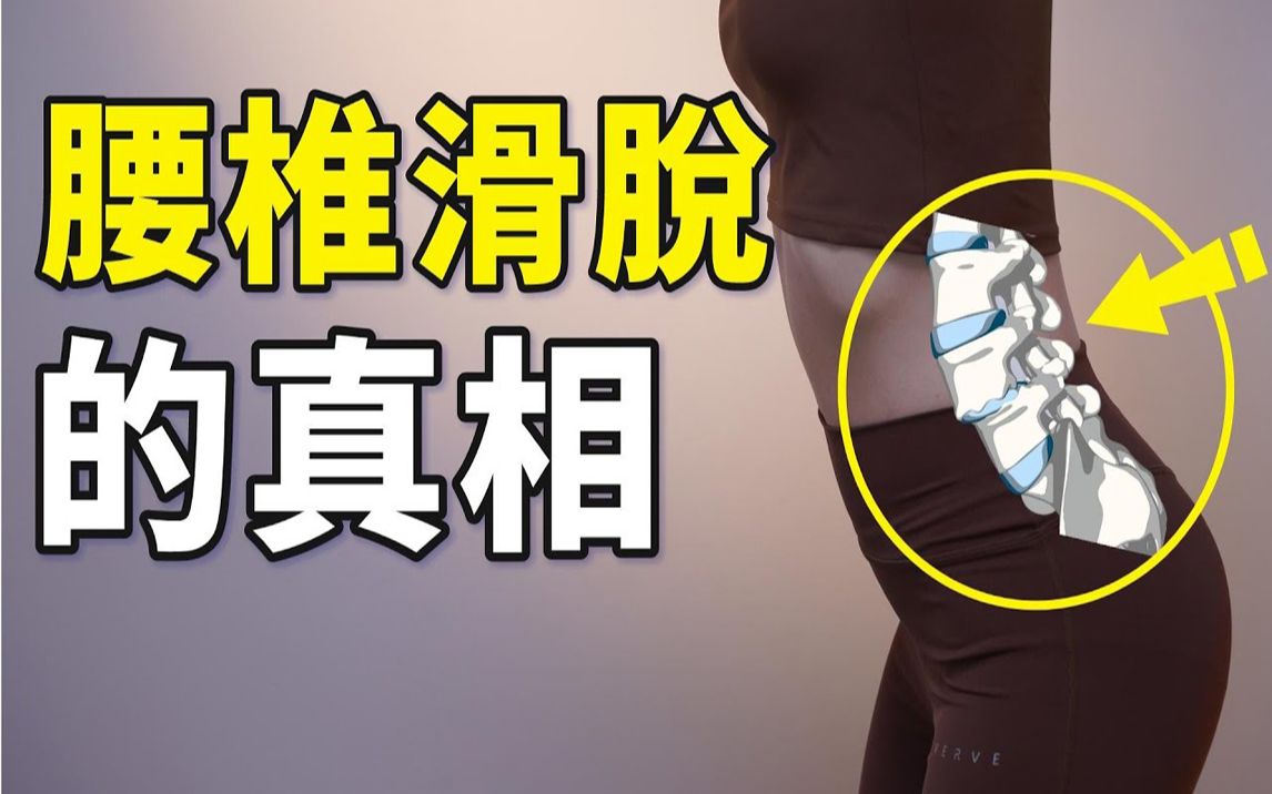 腰椎滑脱如何矫正/预防 腰椎的极限在哪