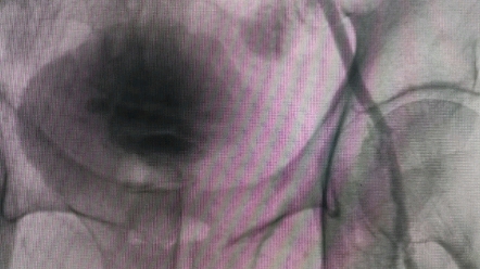 股浅动脉长段闭塞(股腘动脉搭桥术)