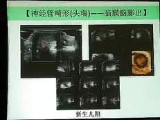 新生儿神经管闭合畸形超声识别及进展(视频)