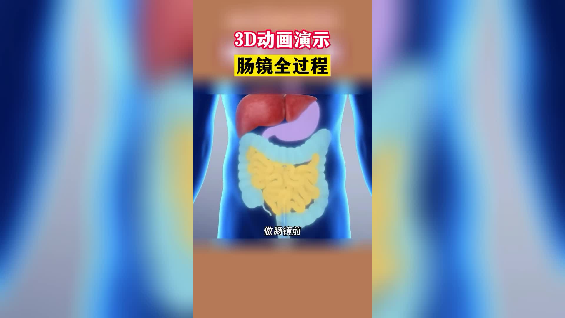 3D动画演示,肠镜的全过程