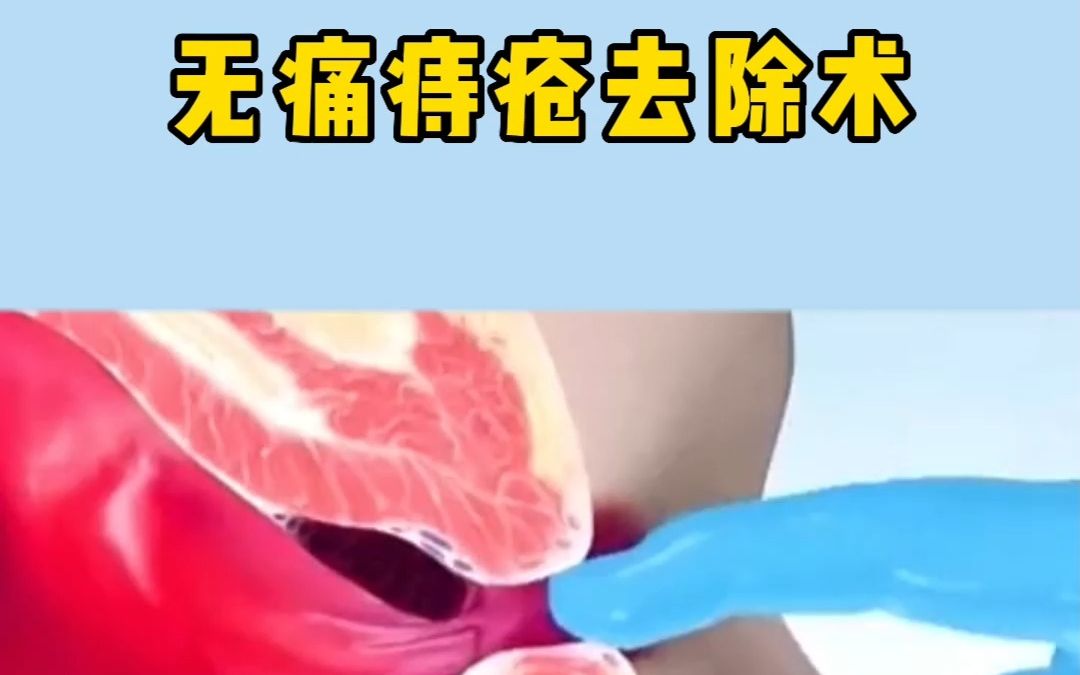 痔疮无痛微创切除术