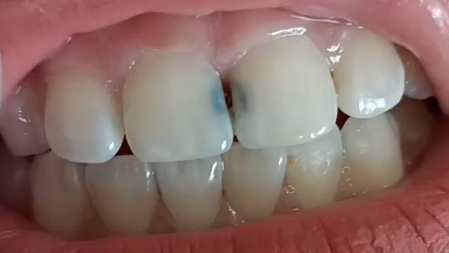 补门牙要花多少钱?看这里! 南京补牙,推荐你到南京德牙联合口腔医院!