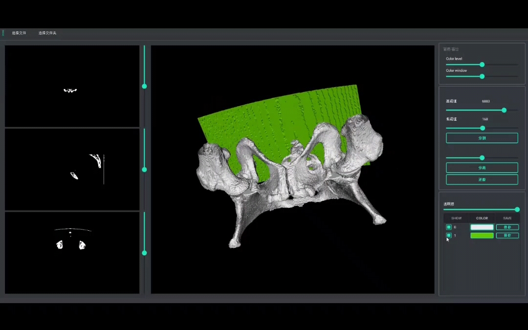 CT三维重建 CT分割 髋部重建 Python PyQt 三维开发