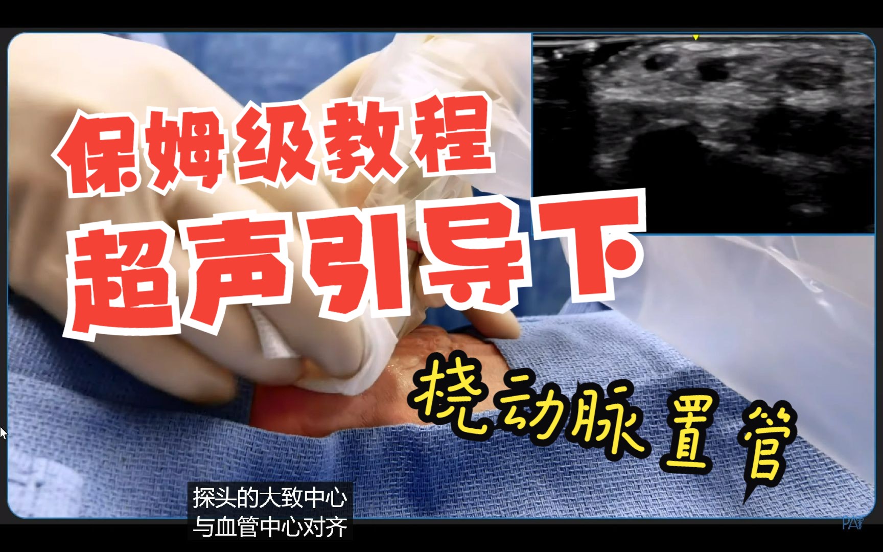 住院总D46-真实场景-超声引导下桡动脉置管