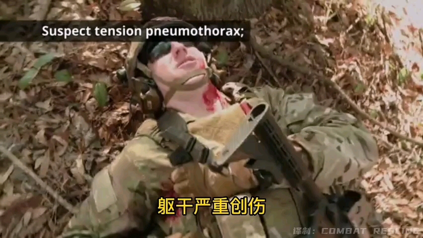 战术急救技能——张力性气胸处置