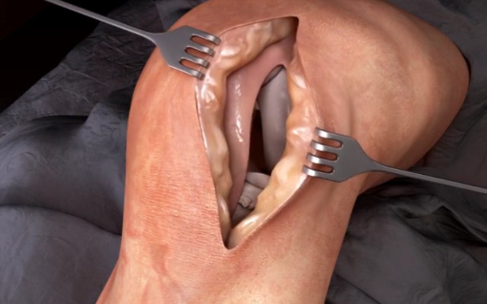 膝关节单髁置换术