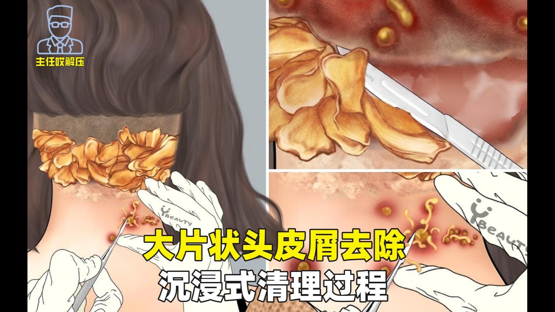 解压动画,大片状头皮屑去除,沉浸式清理过程