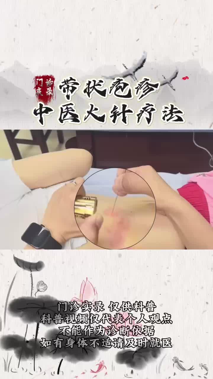 带状疱疹,中医火针疗法#中医 #带状疱疹 #火针 #科普一下