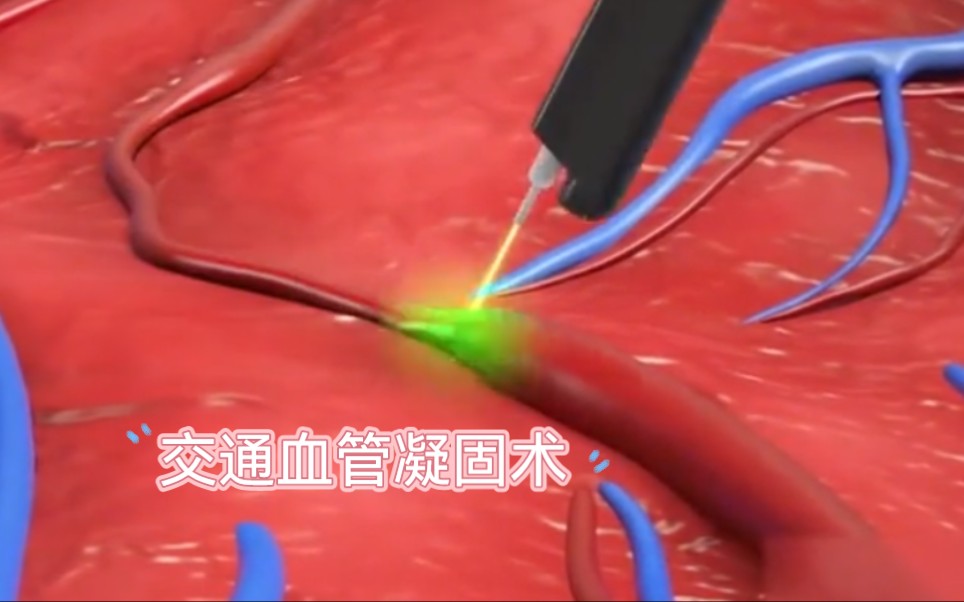 医学3D动画神奇的交通血管凝固术--TTTs-转自腾讯视频