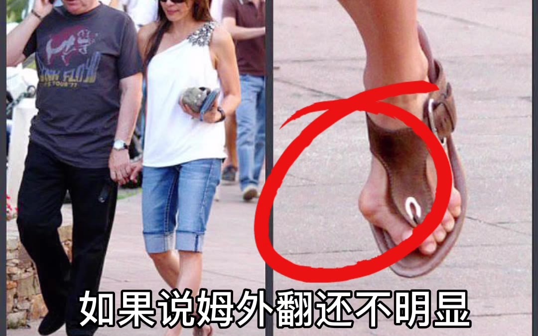 为什么那么多女明星都有拇指外翻?