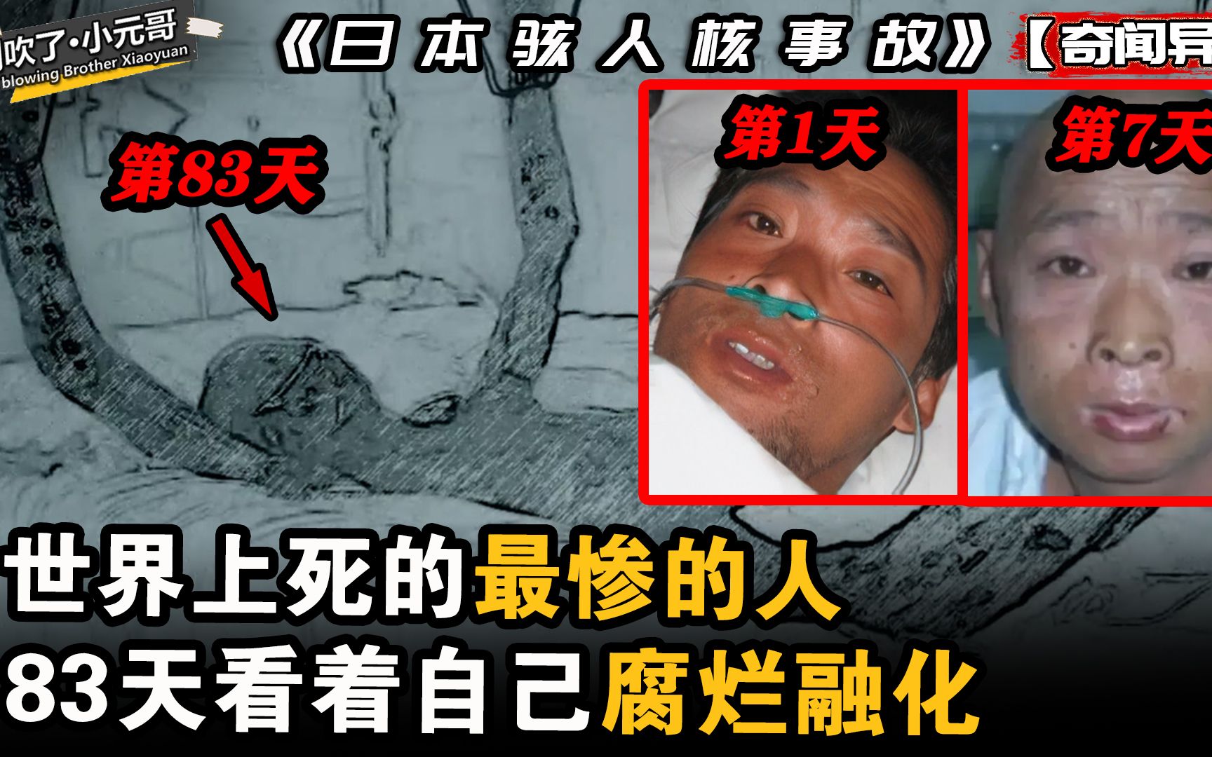 世界上死的最惨的人!被近距离高强度核辐射,在83天内腐烂融化