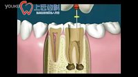 牙齿根管治疗过程