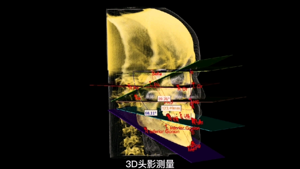mimics数字化口腔,正畸3D三维头影测量
