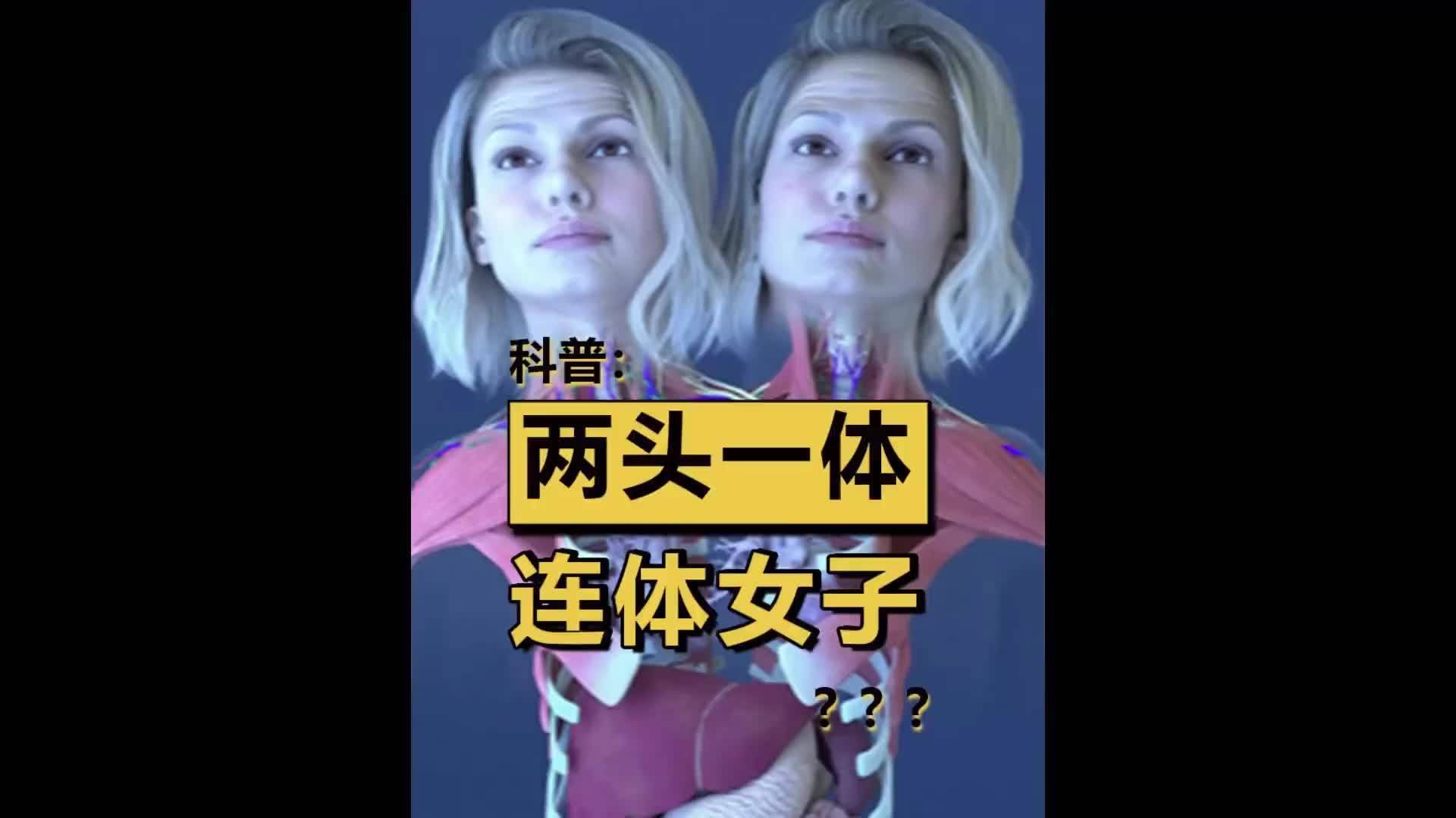 ...、两个胃。两个心脏共用一副躯体和一套生殖系统的连体双胞胎#科普