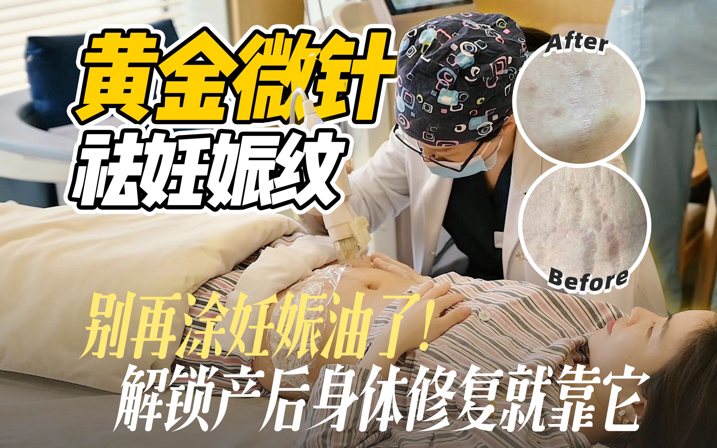 黄金微针祛妊娠纹Vlog|二胎妈妈亲测,90分钟改善妊娠纹,淡不掉的妊娠...