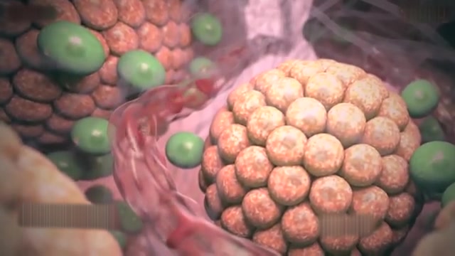 3D动画演示甲状腺结节的发病过程