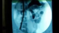 营养治疗视频教程:液囊空肠导管在小肠道造影中的使用(实况录像)