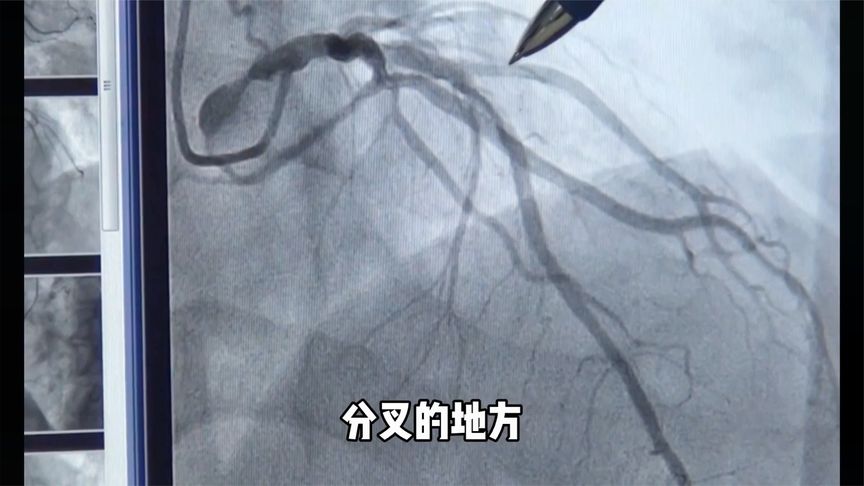 支架后又堵了的血管长什么样?