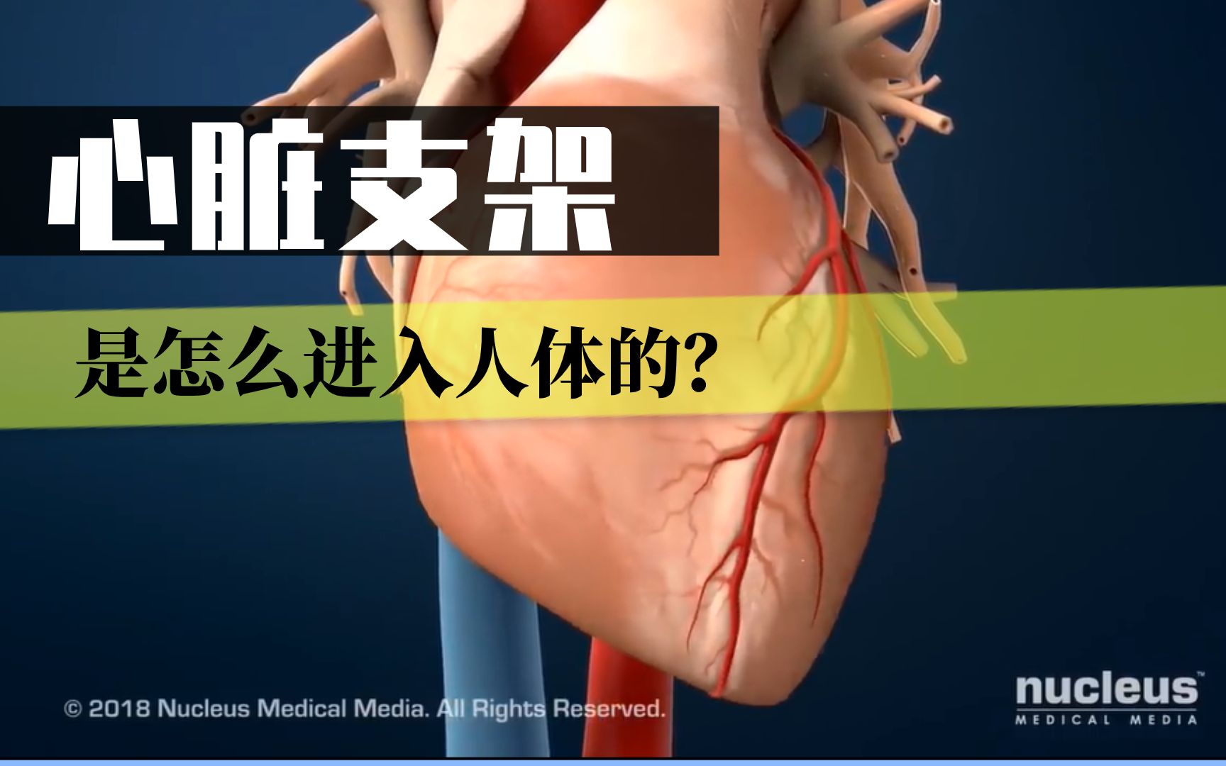 【3D动画模拟】心脏支架是怎么进入人体的?