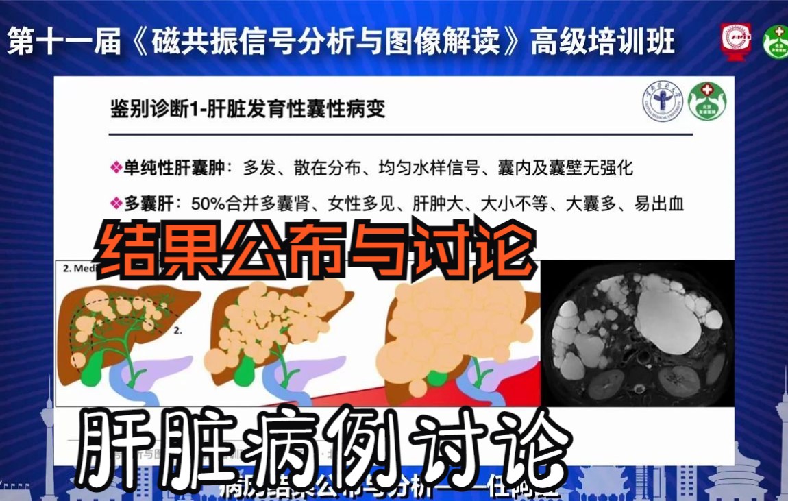 肝脏病例讨论结果公布与讨论