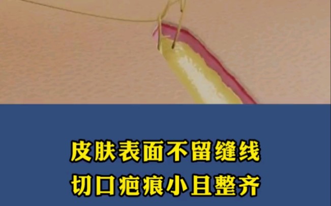 3D演示动画演示:皮下美容缝合