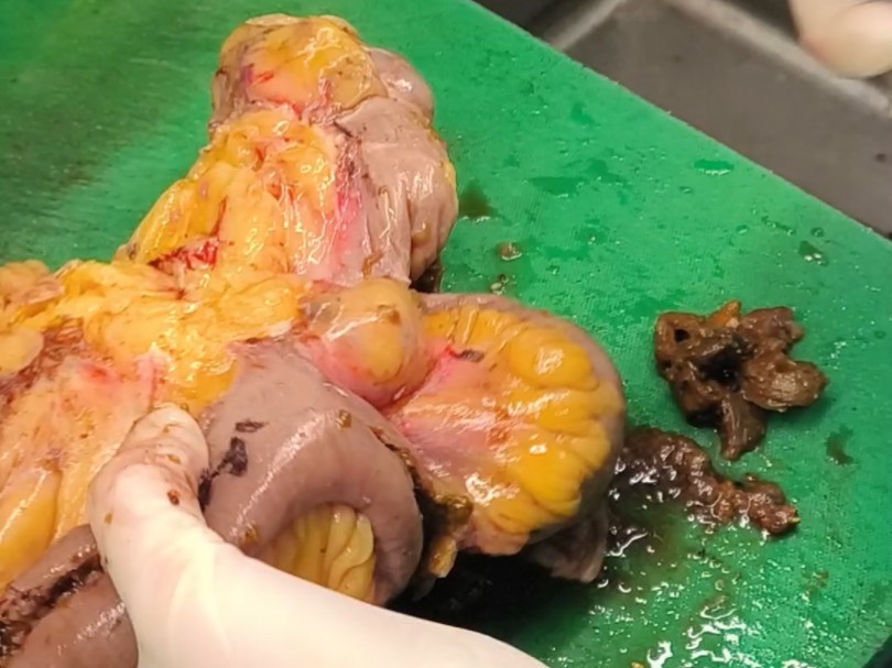 黏连性肠梗阻!粘连性肠梗阻,腹痛、腹胀、呕吐、肛门停止排气排便是...