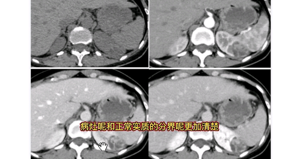 中年女性,体检发现肾脏占位增强CT诊断什么?医生讲解